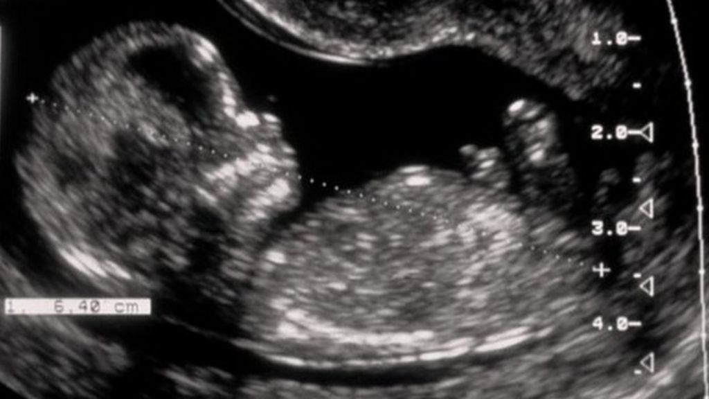 Prof Peter Wells's 55 years developing ultrasound - BBC News