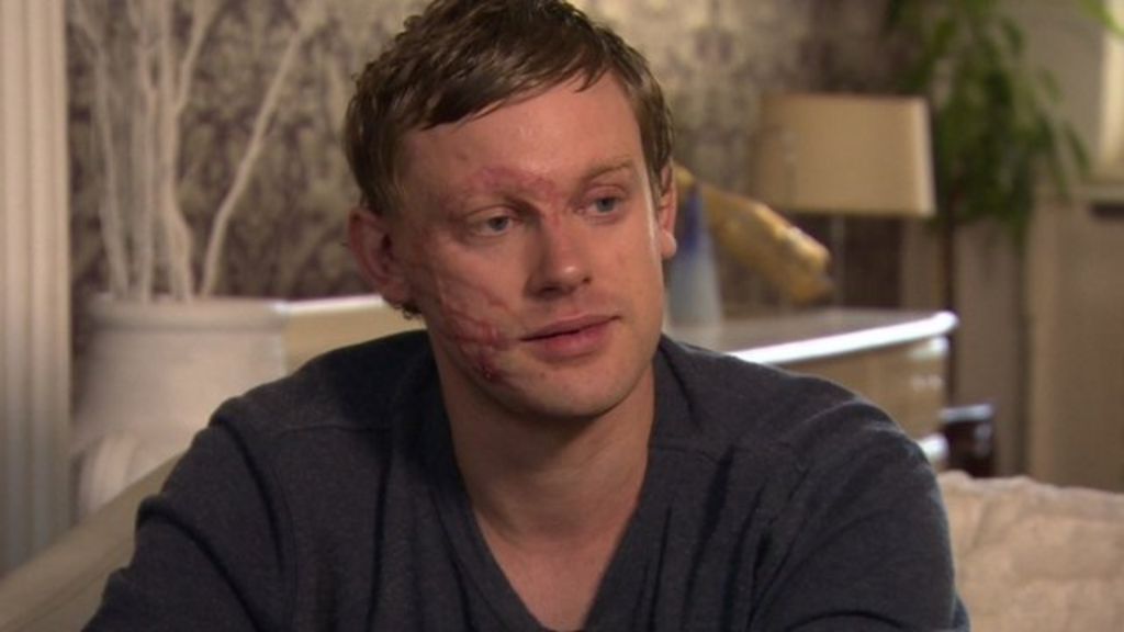 Thundersley acid attack victim Darren Pidgeon describes ordeal - BBC News