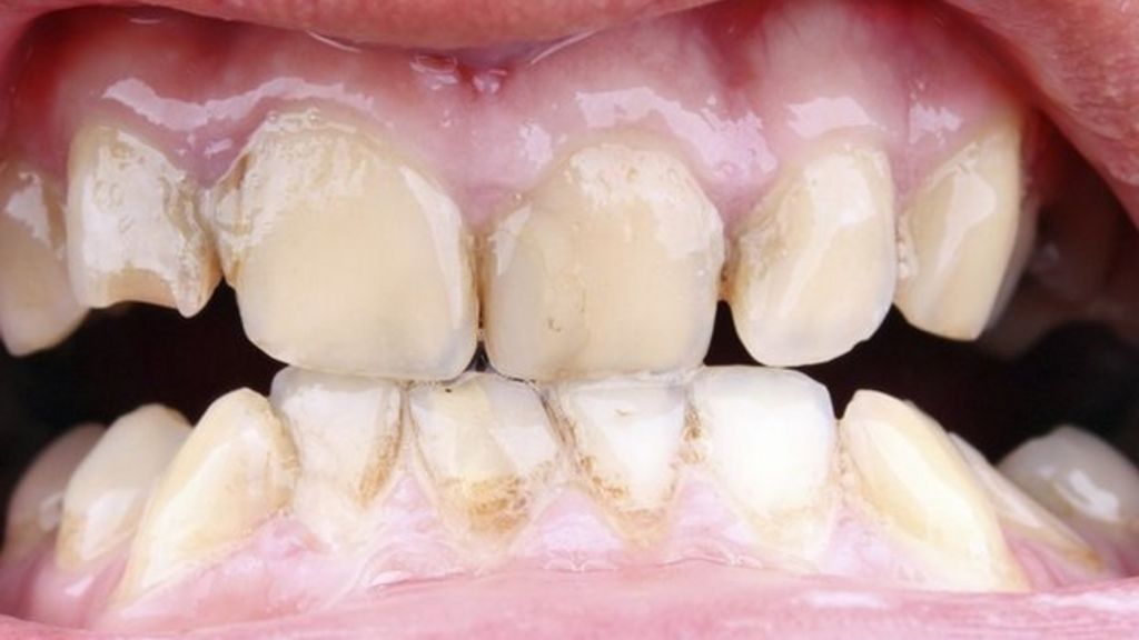 Poor people 'have fewer teeth' than rich, study suggests - BBC News