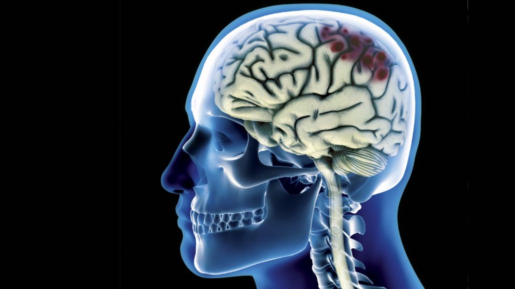 Brain injury: Stories of changed lives - BBC News