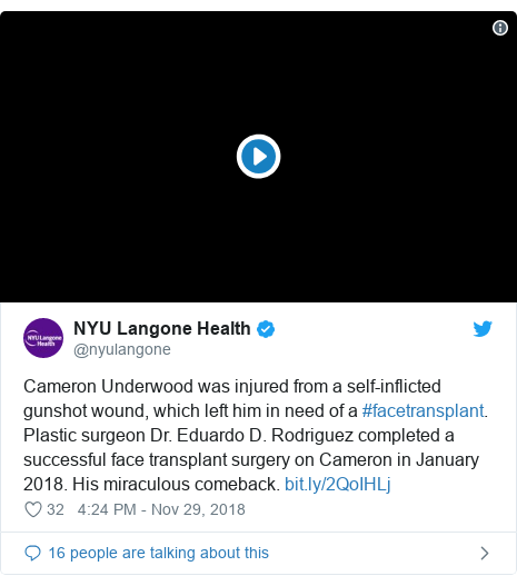 Cameron Underwood: Face transplant means I can smile again - BBC News