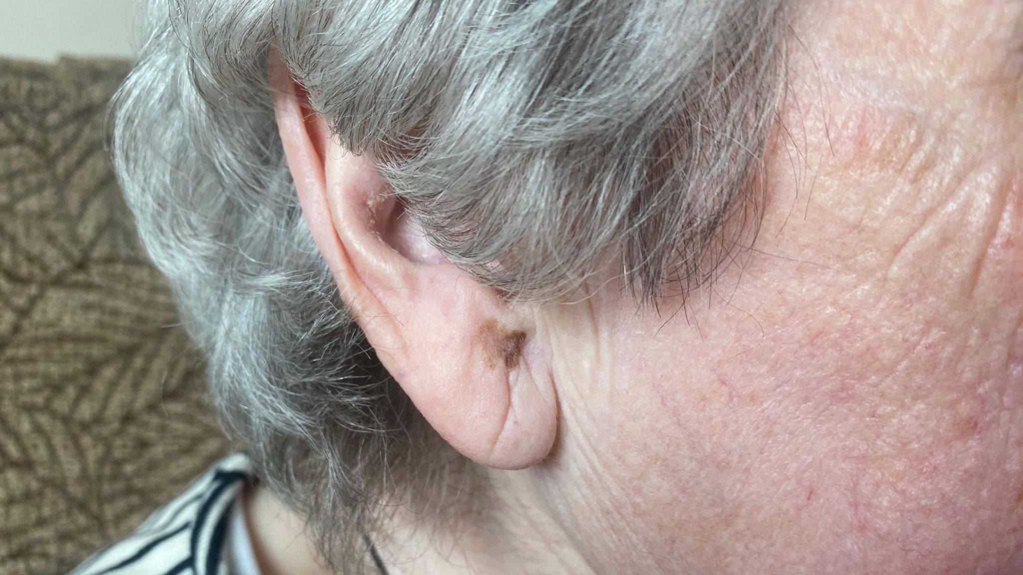 Woman's cancer diagnosis after dentist spots unusual mark on ear - BBC News