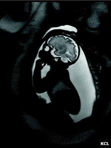 Babies' brains to be mapped in the womb and after birth - BBC News