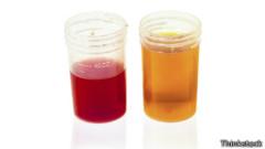 Qué nos dice el color de la orina sobre nuestra salud - BBC News Mundo