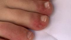 Study reveals why some people get Covid toe condition - BBC News