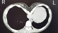 Sunken chest syndrome: 'I'm being strangled inside' - BBC News