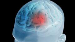 Combined blood and brain tests predict repeat stroke risk - BBC News