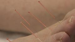 Cancer patient trial finds acupuncture lessens chemotherapy neuropathy ...