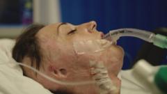 Inside the hospital treating acid attack scars - BBC News