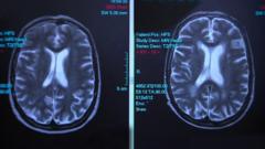 The 'dual stigma' of alcohol-related brain damage - BBC News
