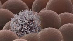 Skin cancer: Half of people surviving advanced melanoma - BBC News