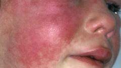 Scarlet fever cases hit 50-year high in England - BBC News