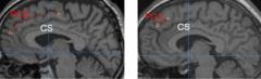 Frontal brain wrinkle linked to hallucinations - BBC News