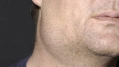 Mumps - is it the forgotten disease? - BBC News