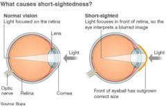 Could glasses soon be history? - BBC News