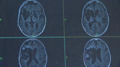 Microwave helmet 'can spot a stroke' - BBC News