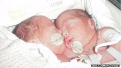 Conjoined twins Rosie and Ruby Formosa separated - BBC News