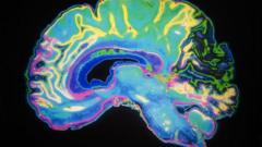 'It's just my brain is misbehaving' - BBC News