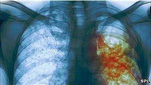 La tuberculosis resistente a las medicinas hace saltar la alarma en ...