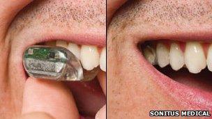 Dental hearing aid gets approved in Europe - BBC News