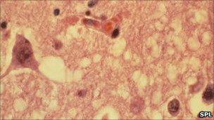 More patients at risk from CJD after surgery - BBC News