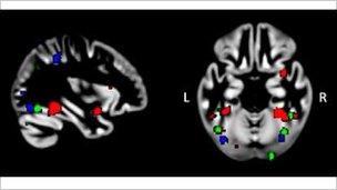 Autistic brains "organised differently" say scientists - BBC News