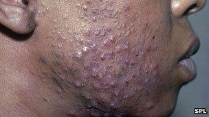 Why spotting the best acne treatment is a pain - BBC News