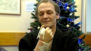 Thumbs up for man's toe swap operation - BBC News