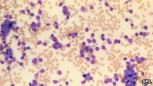 Drug hope for leukaemia patients after Cardiff trial - BBC News
