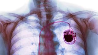 The woman who wanted her pacemaker turned off - BBC News