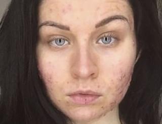 'I woke up one day with severe acne' - BBC News