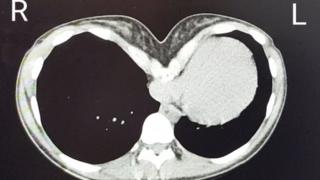 Sunken chest syndrome: 'I'm being strangled inside' - BBC News