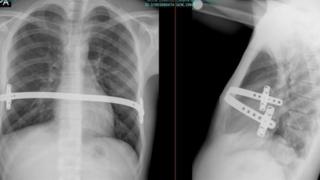 Sunken chest syndrome: 'I'm being strangled inside' - BBC News
