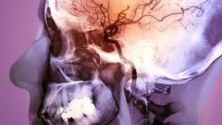 Microwave helmet 'can spot a stroke' - BBC News