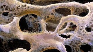Protein could bring hope to brittle bone disease - BBC News
