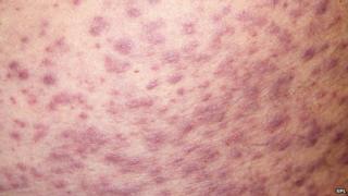 Doctors' allergy mistakes 'risking lives' - BBC News