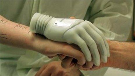 Woman considers hand removal for bionic replacement - BBC News