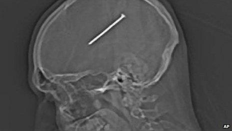 Man shoots nail into brain without noticing - BBC News