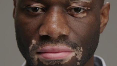 Stoke-on-Trent man with vitiligo wants be role model he never had - BBC ...