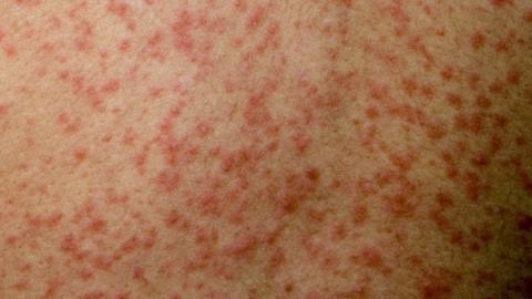 Measles outbreak feared in London and South East - BBC News
