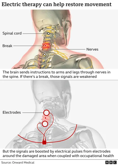 Electric pulses may restore movement in people with broken necks.
