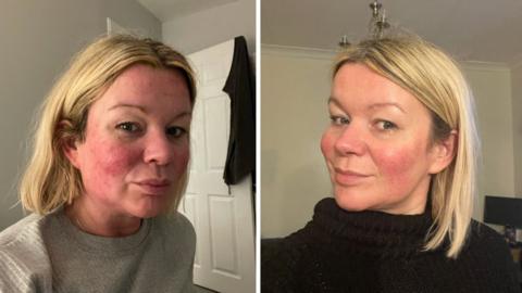 Rosacea: 'Your skin doesn't define you' - BBC News