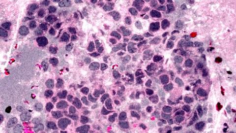Lasers help doctors remove brain cancer - BBC News