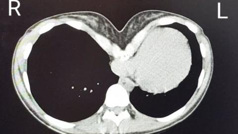 Sunken chest syndrome: 'I'm being strangled inside' - BBC News