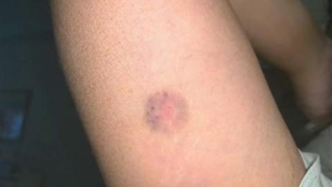 Spiked Gloucester student backs MP to make act a crime - BBC News