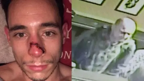 Cardiff nose bite victim left 'scarred for life'