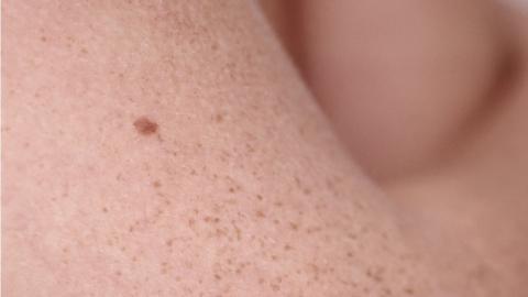 Arm mole count 'predicts skin cancer risk' - BBC News