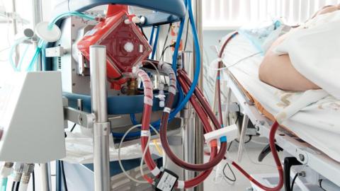 ECMO คืออะไร ทำงานอย่างไร ในผู้ป่วยหัวใจผิดปกติ - BBC News ไทย