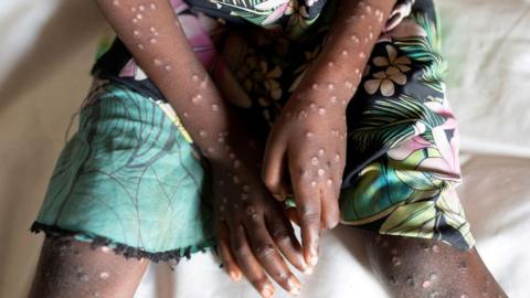 Central African Republic latest to declare mpox outbreak - BBC News