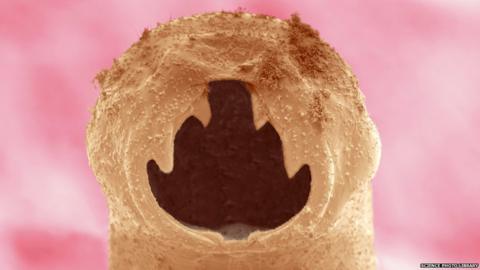 Is it worth treating everyone who might get worms? - BBC News